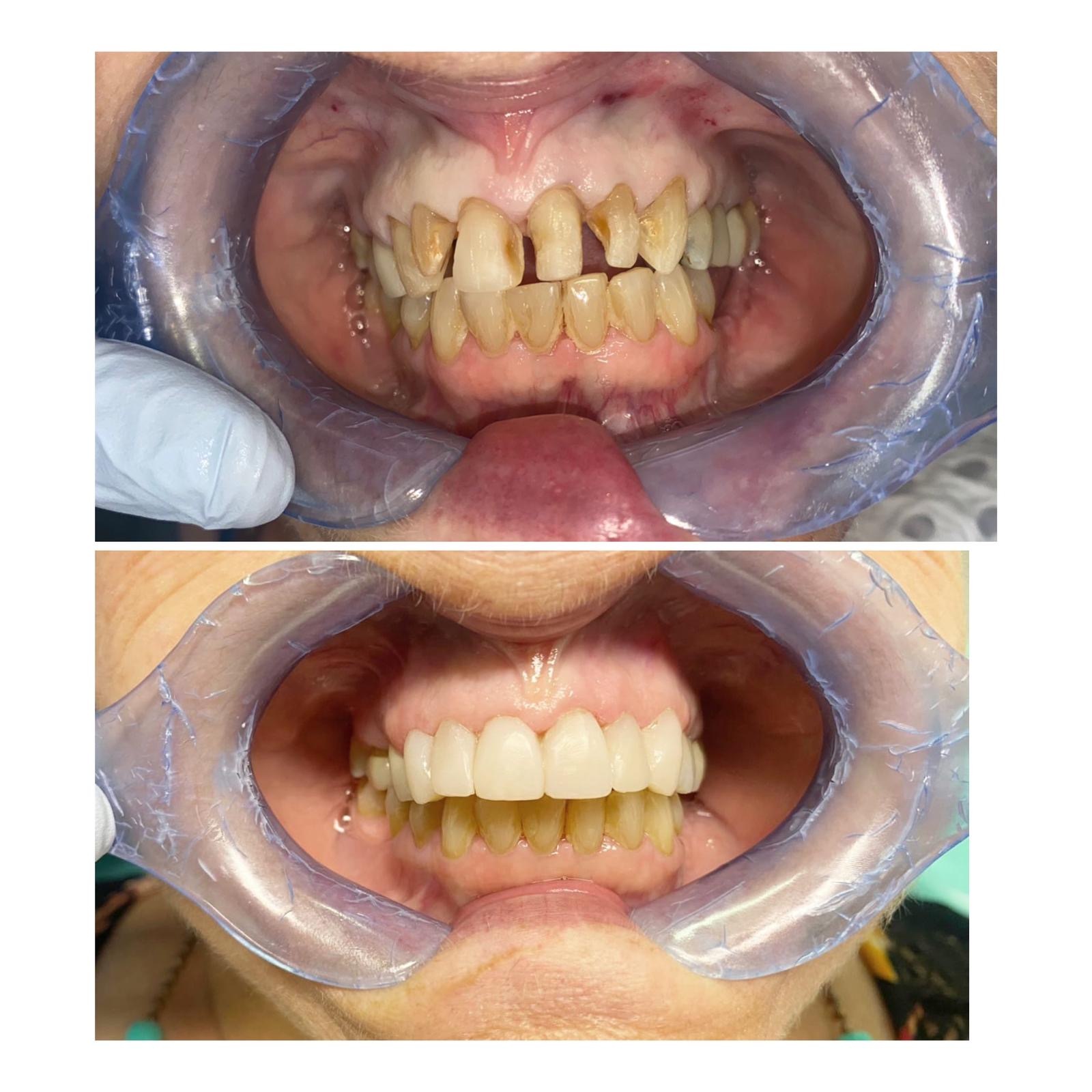 Injectable Veneers Somerset Dental Care | Narellan NSW